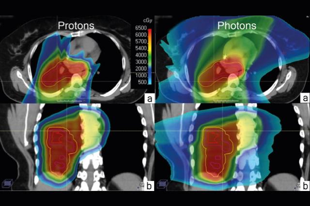 Treating thoracic cancers with proton therapy | IBA Campus